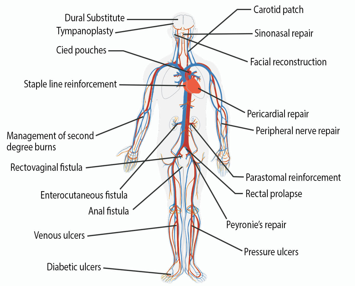 Pericardial patch – Dastavarde Sina